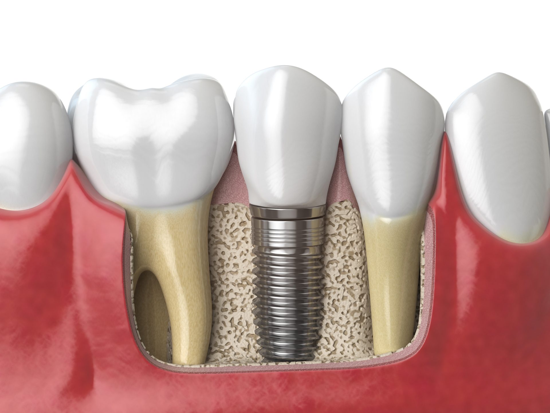 Dental Implants - Fingerpost Dental Clinic Douglas