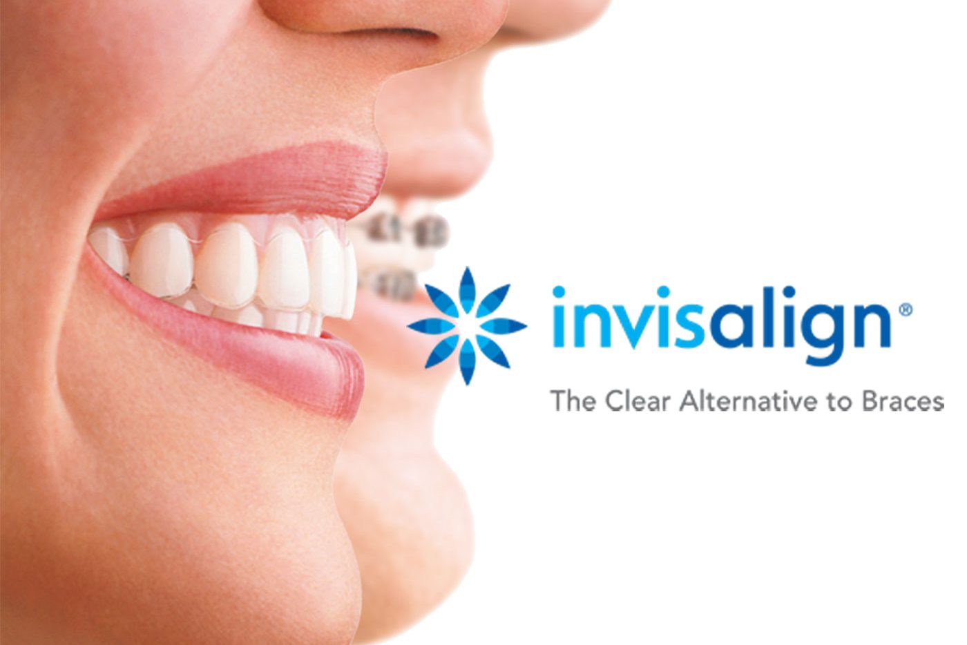 Invisalign - Fingerpost Dental Clinic Douglas